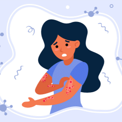 Comment reconnaître et traiter l'urticaire ? | KitPatient