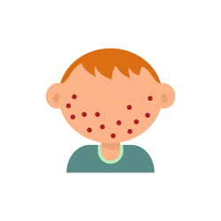 La varicelle : comprendre cette maladie infectieuse virale (VZV)