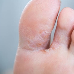 Les mycoses cutanées : causes, examens et traitements